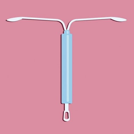 Getting an IUD - What You Need to Know | Advantia Health